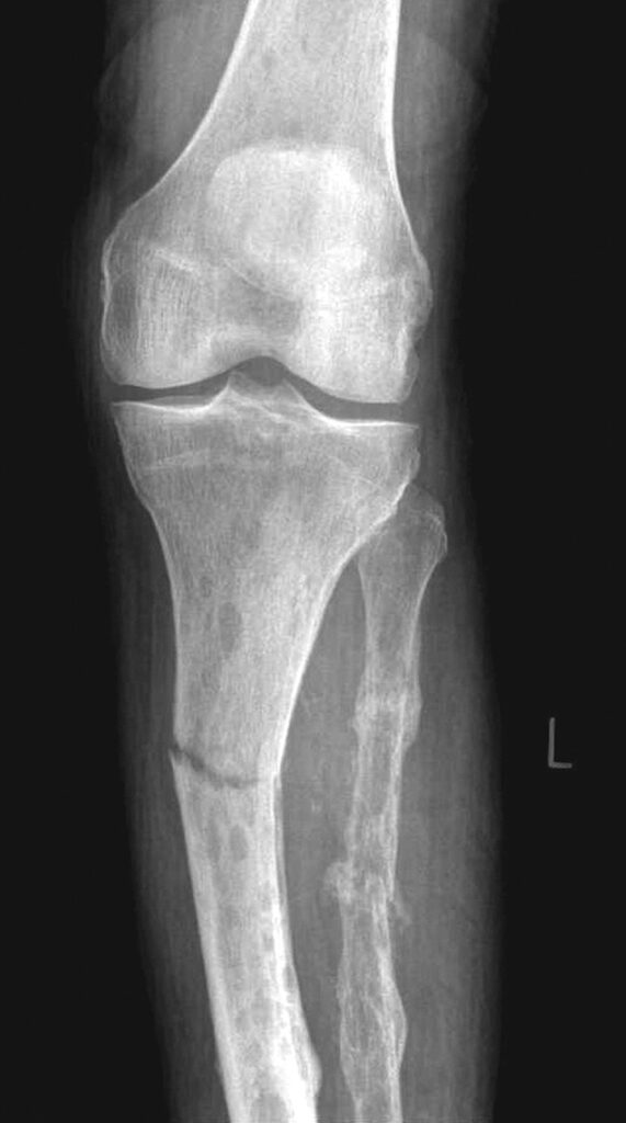Plasmozytom des Knochens/Multiples Myelom