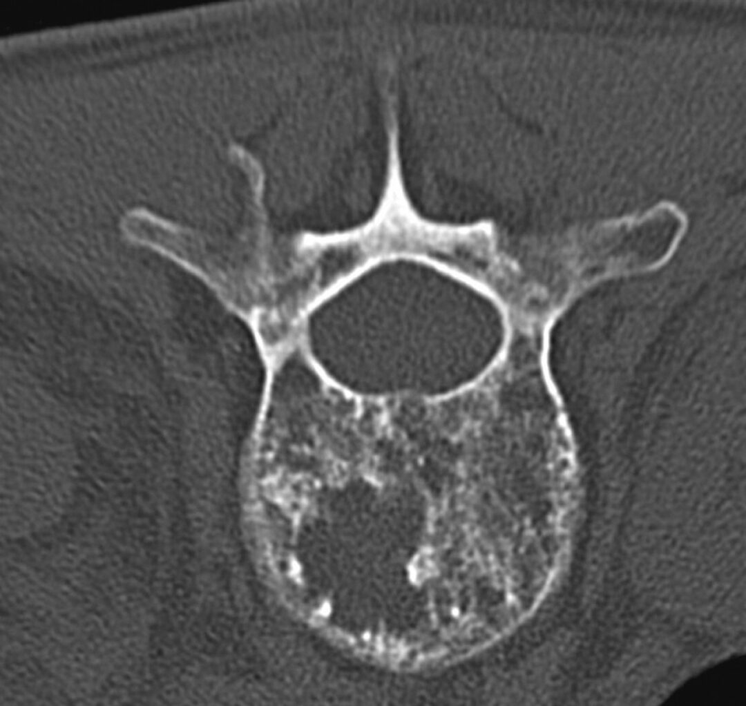 Plasmozytom des Knochens/Multiples Myelom