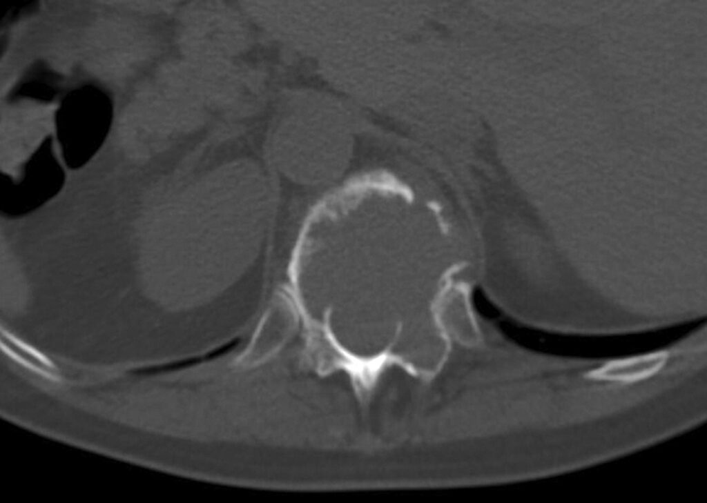 Plasmozytom des Knochens/Multiples Myelom