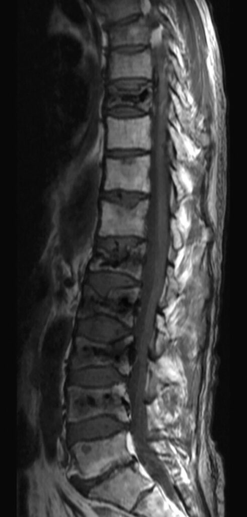 Plasmozytom des Knochens/Multiples Myelom