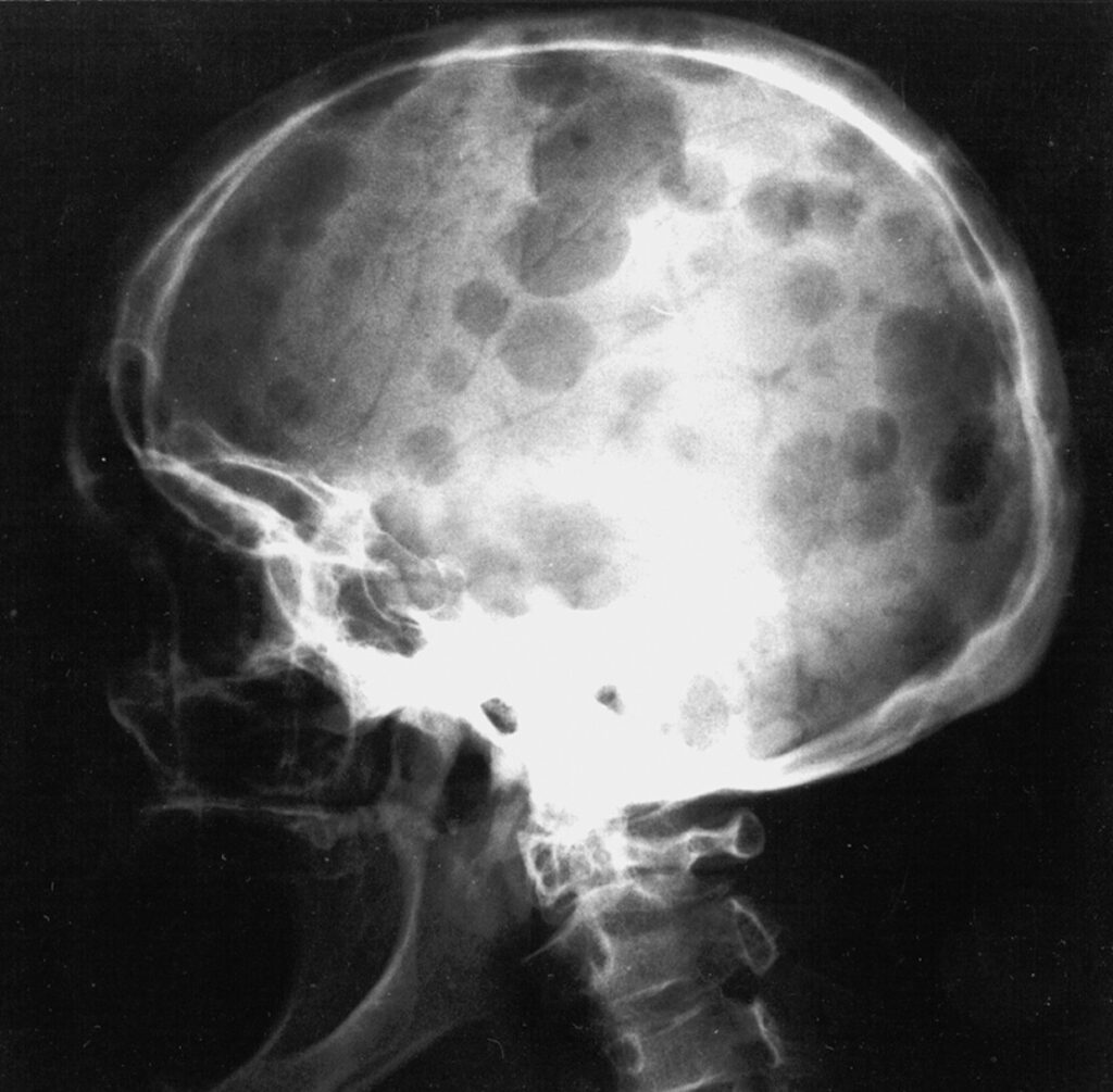Plasmozytom des Knochens/Multiples Myelom