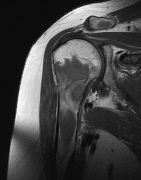 Plasmozytom des Knochens/Multiples Myelom